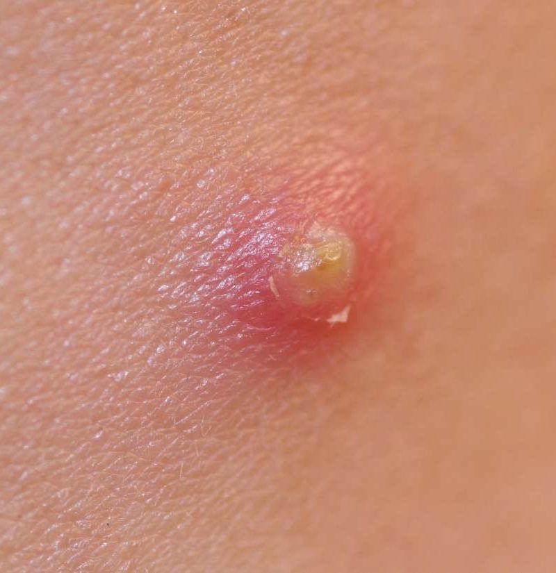 Pústulas: Por qué aparecen y cuáles son los tratamientos más efectivos