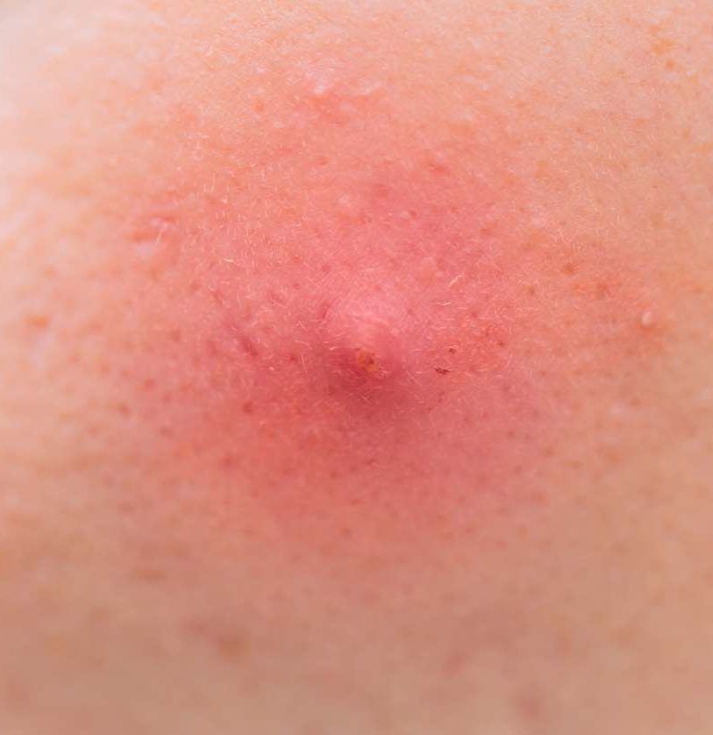 Armpit pimple: Types, causes, and treatments