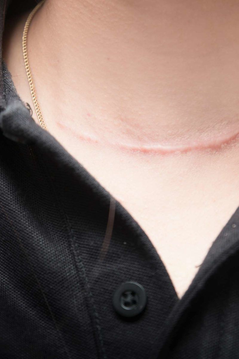 Laser treatment for scars: What to consider, procedure, and safety