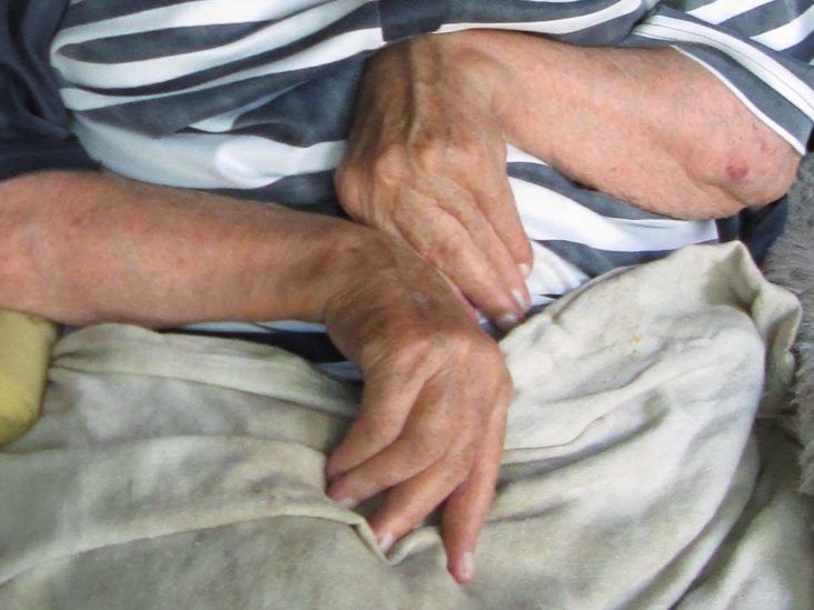 Heberden39s Nodes Causes Symptoms And Treatment Swollen Lymph Nodes: