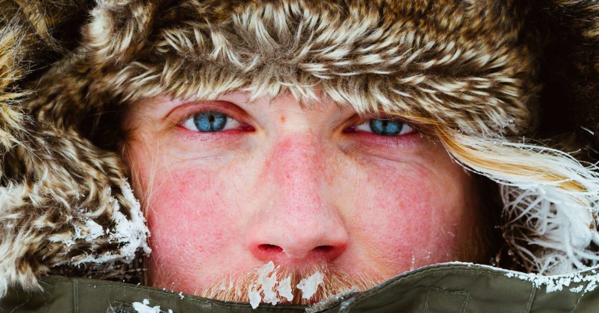 Wind Burn On Lips Treatment You - Infoupdate.org