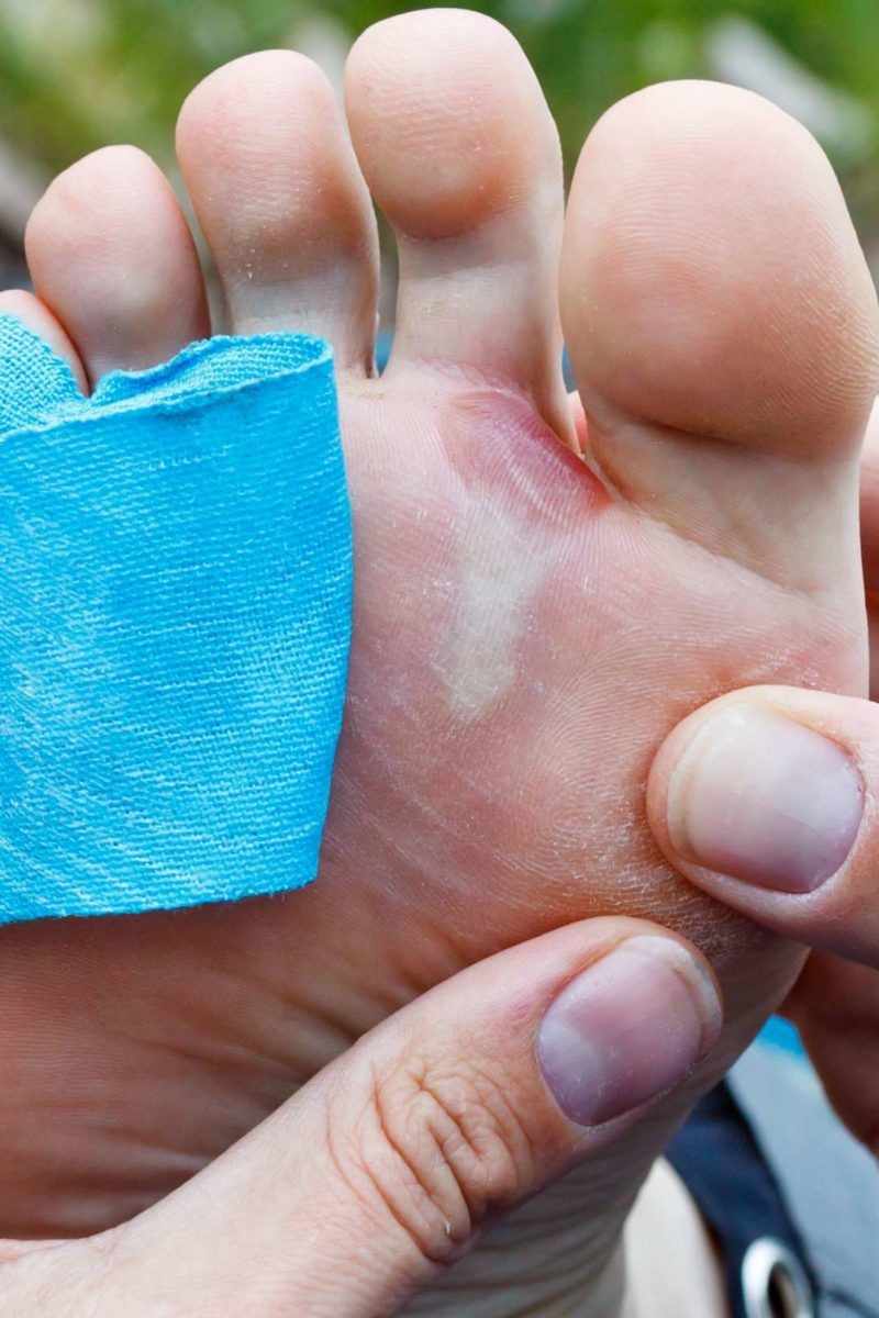 Popping burn blister store