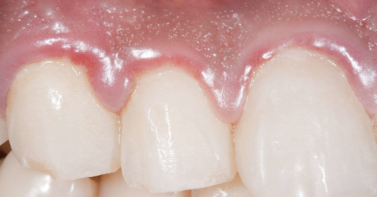 Swollen gums: Causes, treatments, and home remedies