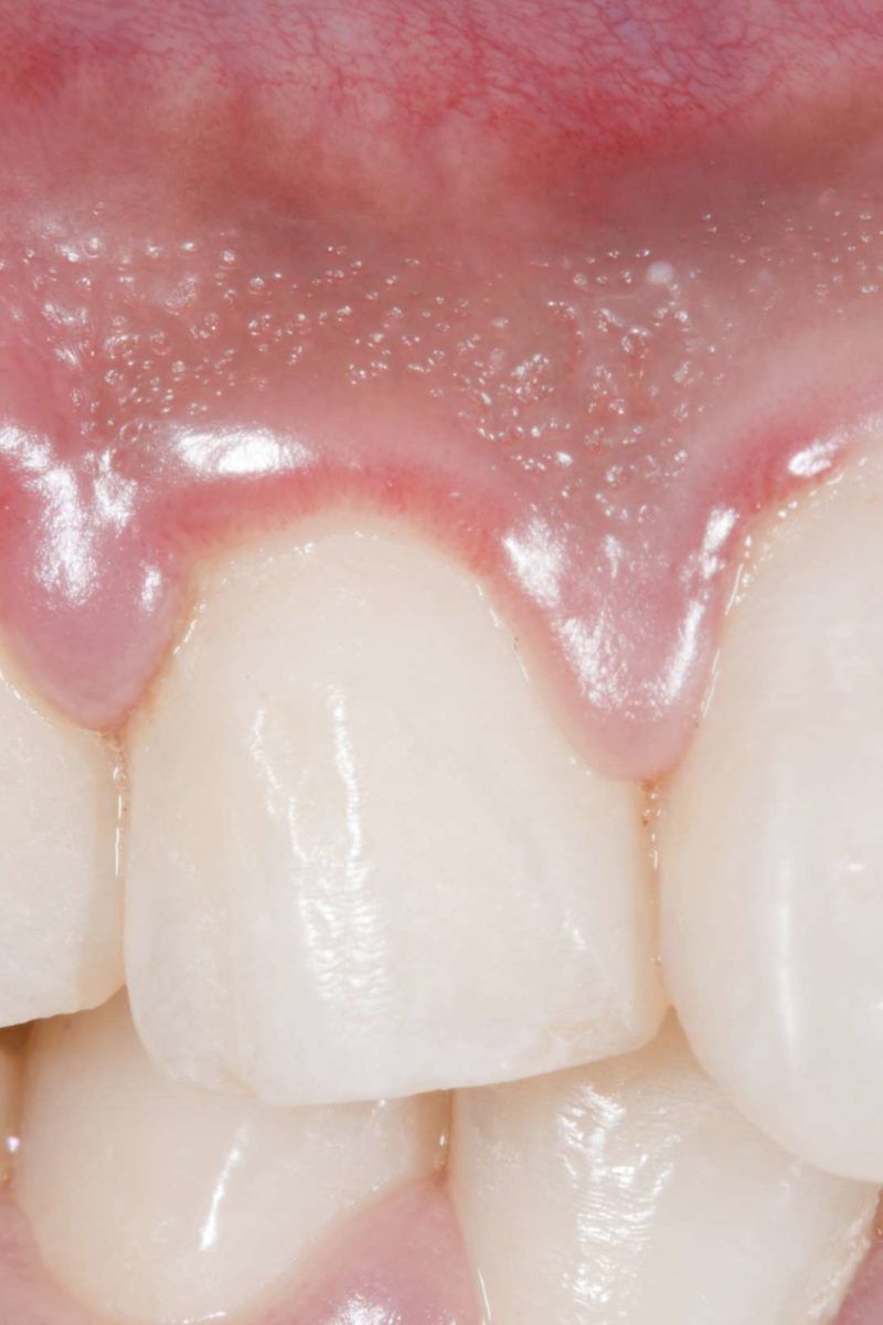 Swollen gums: Causes, treatments, and home remedies
