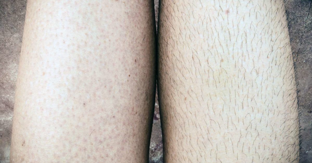 How to get rid of strawberry legs: Treatment and prevention