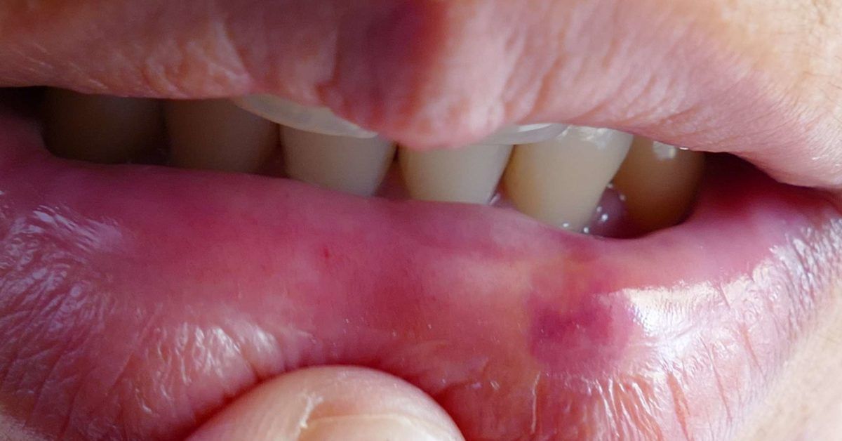 Busted lip: 9 treatments and home remedies