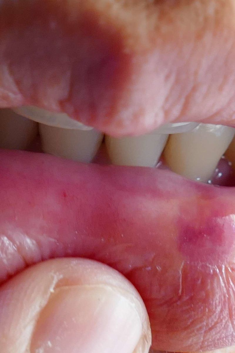 Busted lip: 9 treatments and home remedies