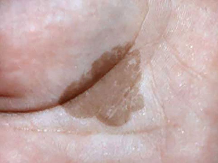 Tinea nigra: Diagnosis, treatment, and remedies