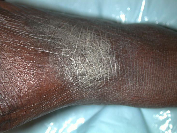 Lichenification: Definition, pictures, and treatment