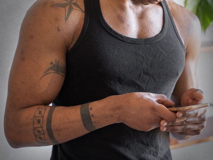 Comedonal acne: Pictures, treatment, and remedies