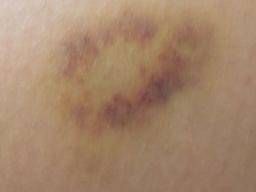 Yellow bruise on the breast: Causes, home remedies, and skin changes