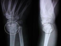 Colles fracture: Causes, symptoms, and diagnosis