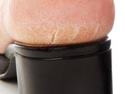 6 fixes for cracked heels