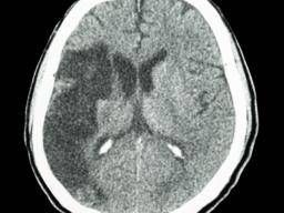 CT scans 'can predict risk of stroke' in TIA patients