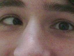 Esotropia: Types, symptoms, and treatment