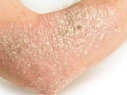 Eczema Yeast Can Be Killed Off, Raising Hope Of New Treatments