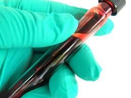 Oral thrush a common complication of HIV 'because of fungi'