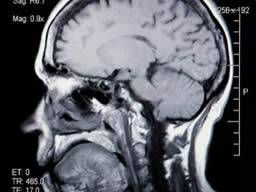 Migraine Patients Have Brain Abnormalities, MRI Scans Show