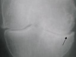 Joint space narrowing: Treatment, causes, and more