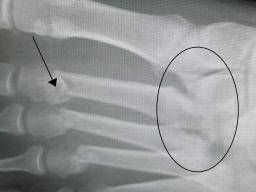 Lisfranc fracture: Causes, symptoms, and treatment