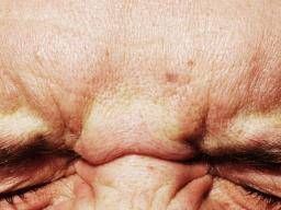 Hyperalgesia: Causes, types, and treatment