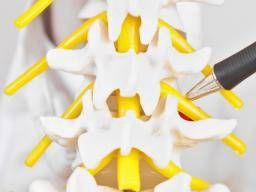 Neural foraminal stenosis: Definition, causes, and treatment