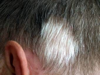 Poliosis: Causes, symptoms, and treatment