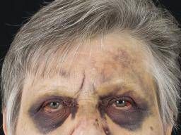 Raccoon eyes: Causes and treatments