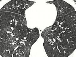 Popcorn lung: Causes, symptoms, and treatment