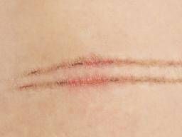 Koebner phenomenon in psoriasis: Causes, treatment, prevention