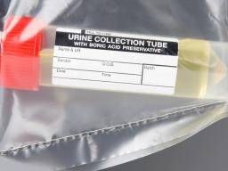 Urine test for diabetes: Types, procedures, results