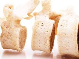 Retrolisthesis: Types, causes, and symptoms