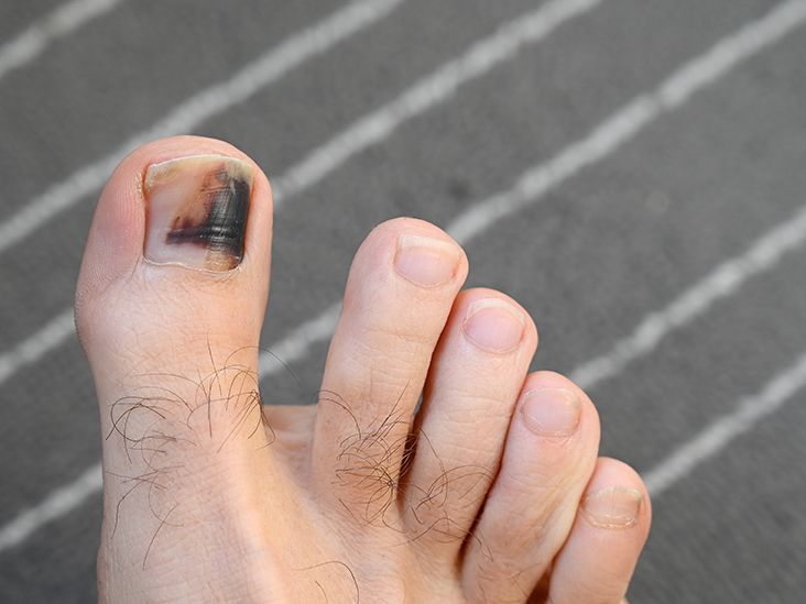 Nail trauma store
