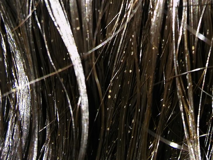 White piedra: Pictures, symptoms, treatment, and more