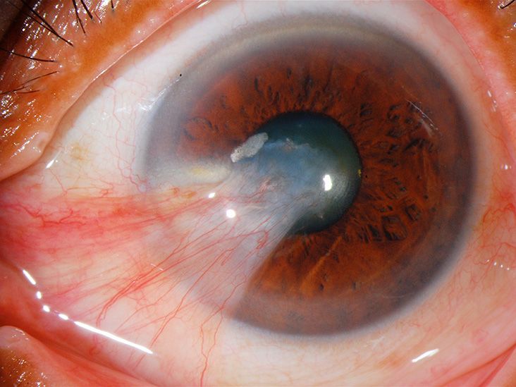 What is a pterygium? Definition, causes, and treatment