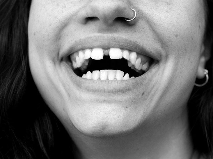 Smiling depression: Symptoms, treatment, and what to know