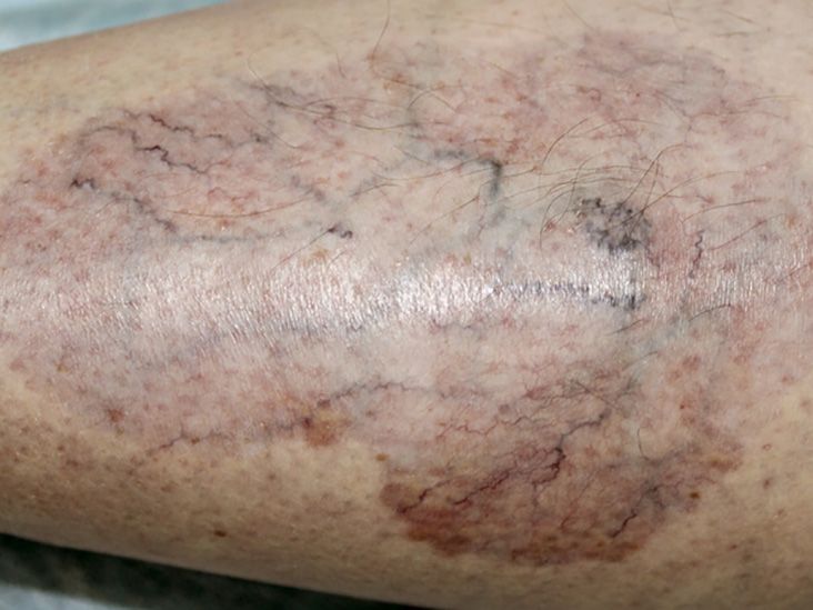 Necrobiosis lipoidica: Definition, causes, risk factors, and treatment