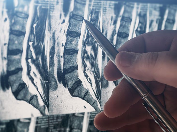 Pinched Nerve In The Back How To Tell Causes And Treatments