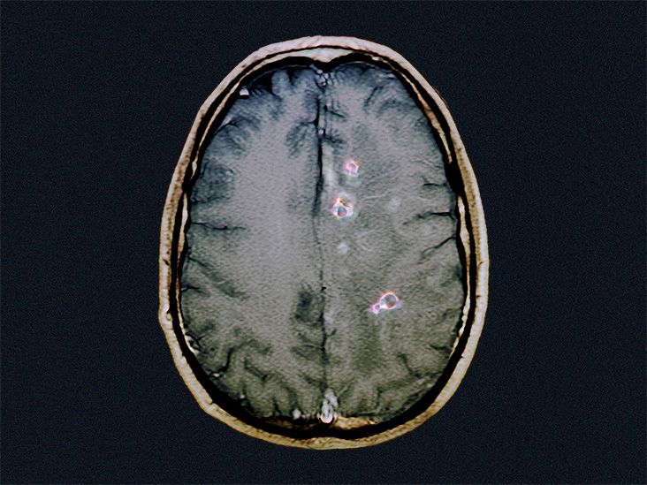 Neurocysticercosis: Definition, symptoms, and treatment