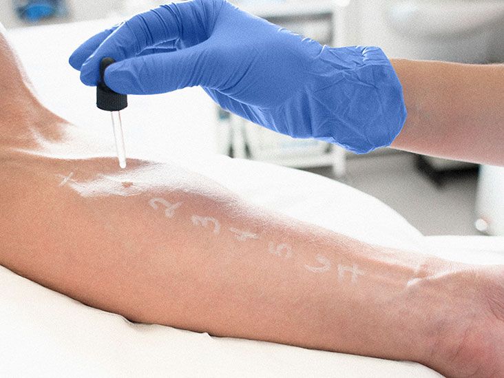 Medicare allergy testing: What is covered?