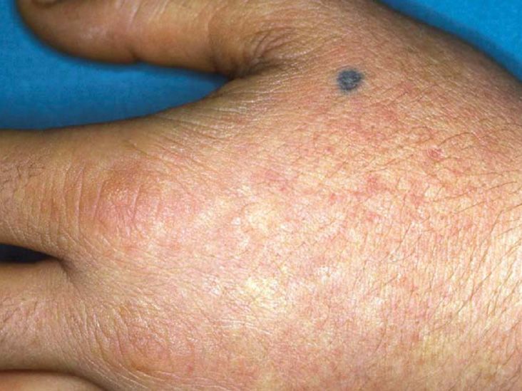 Erythropoietic protoporphyria: Definition, causes, symptoms, and more