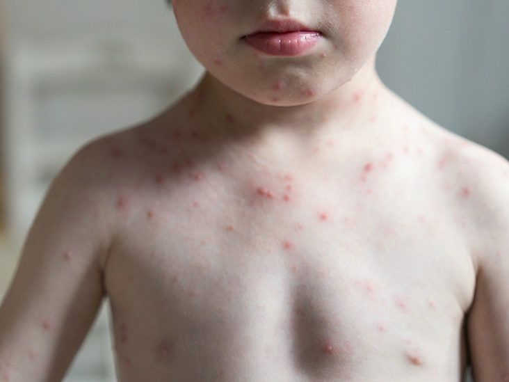Rashes On Kids
