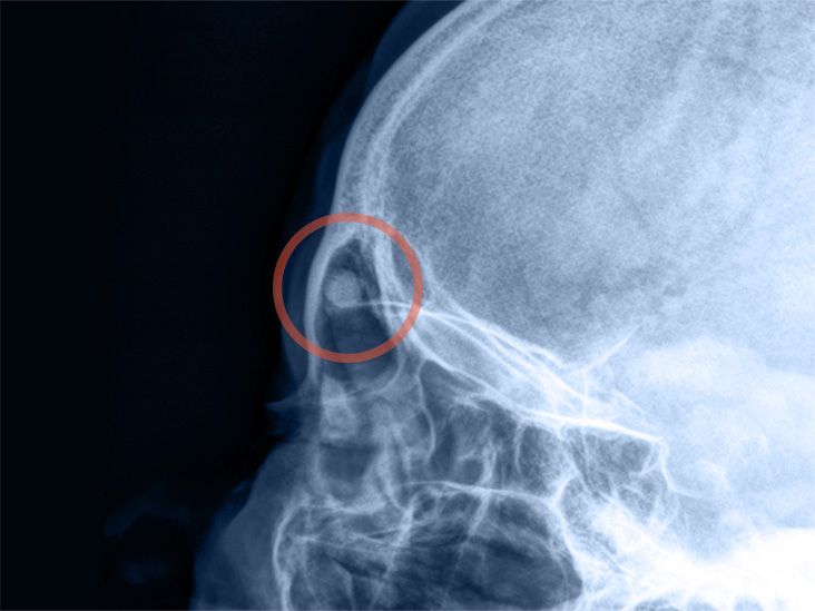 Osteoma: Causes, treatment, removal, diagnosis, and outlook