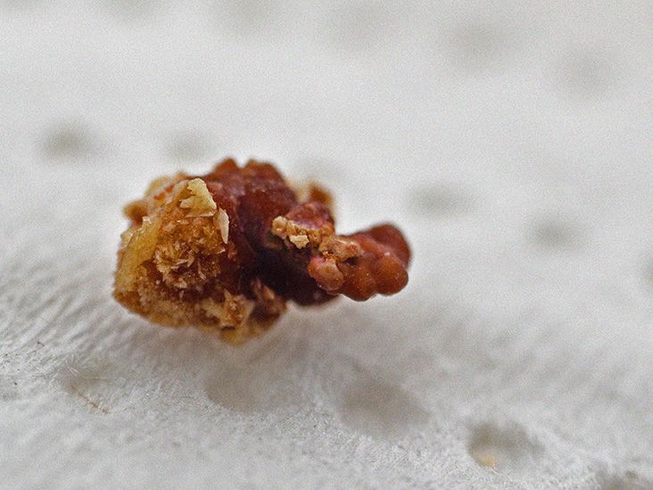 Kidney stones pictures: Visuals, symptoms, and treatment