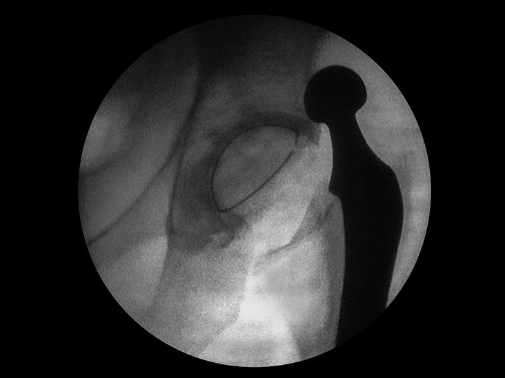 Dislocated hip: Symptoms, treatment, and recovery