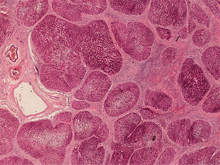 Liver failure: Stages, treatment options, outlook, and more