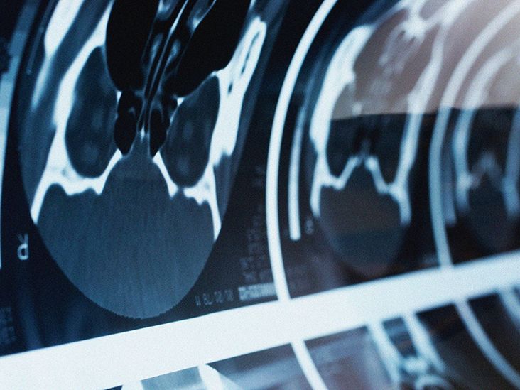 Cyst in brain: Arachnoid, pineal, removal, and more