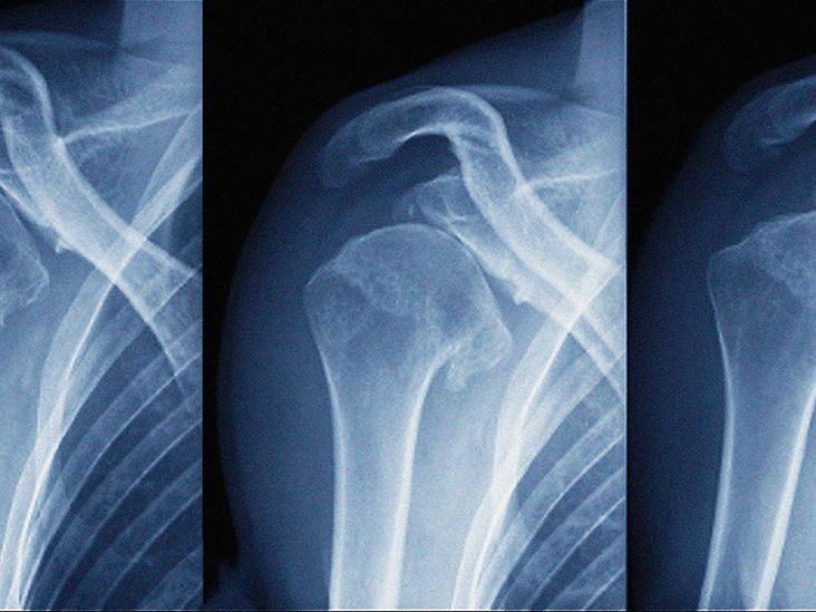 Dislocated shoulder: What to do, symptoms, treatment, and more