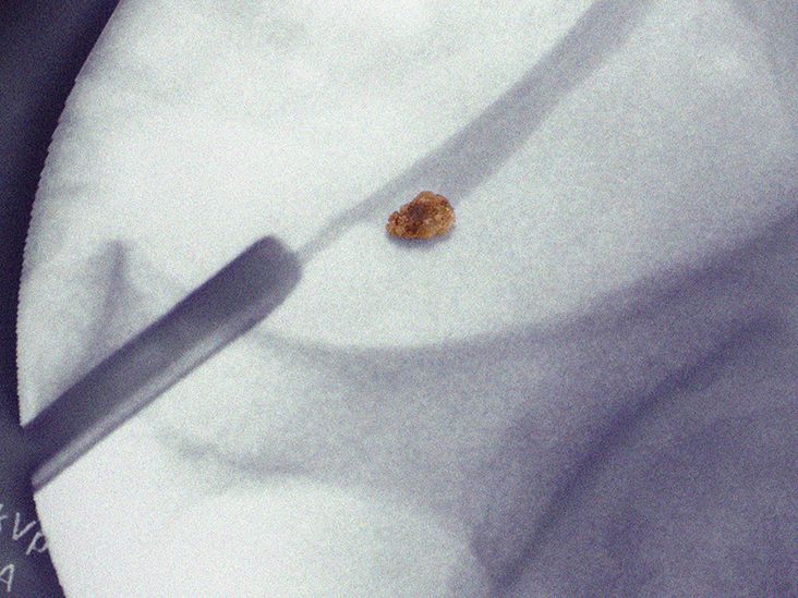 Kidney stones: Causes, symptoms, and treatment