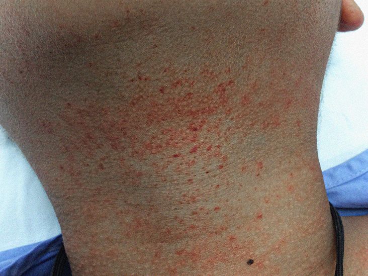 Purpura vs petechaie: Differences, causes, and treatments